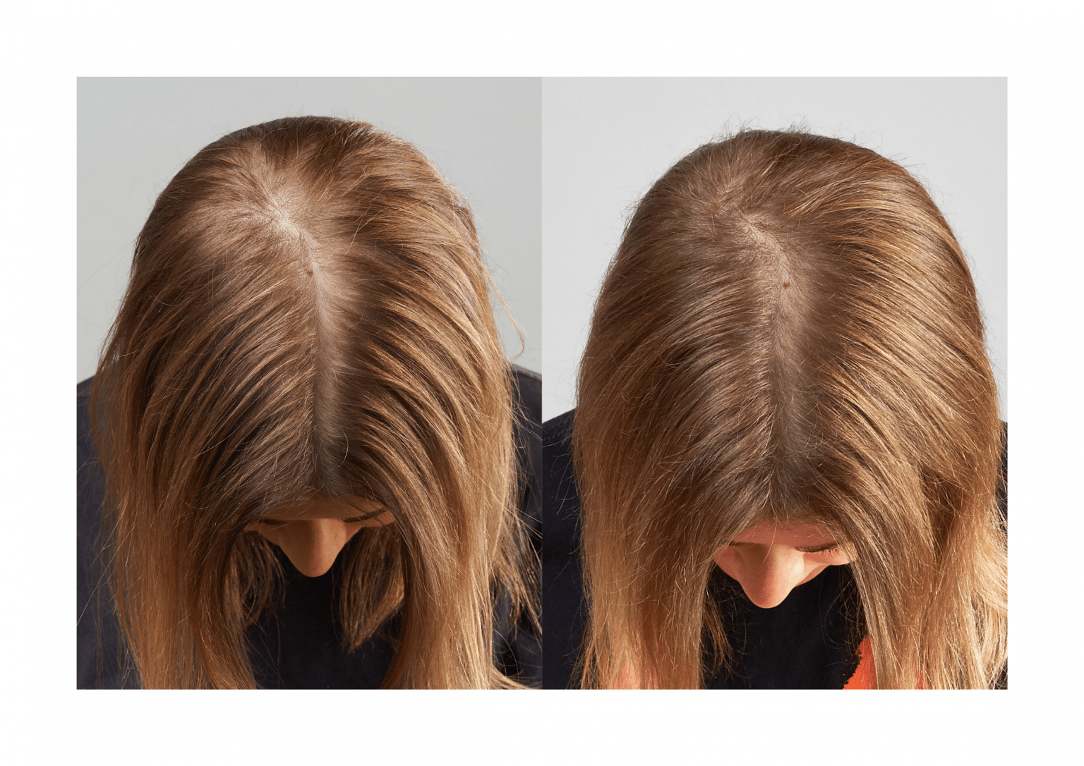 Hers Hair Reviews | Should You Try It? - Beautylectual